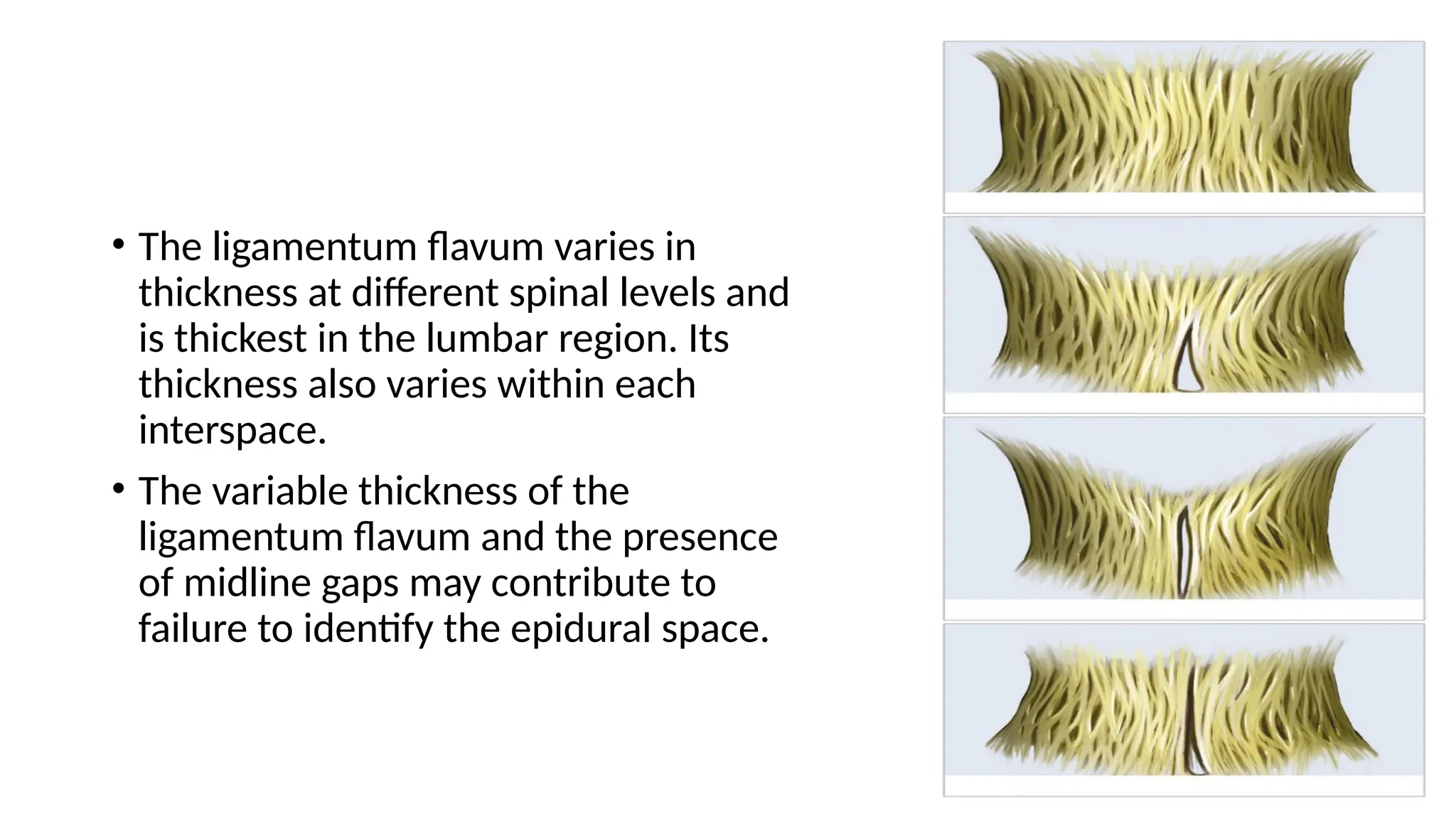 EPIDURAL ANESTHESIA AND ANALGESIA with its consideration | PPTX