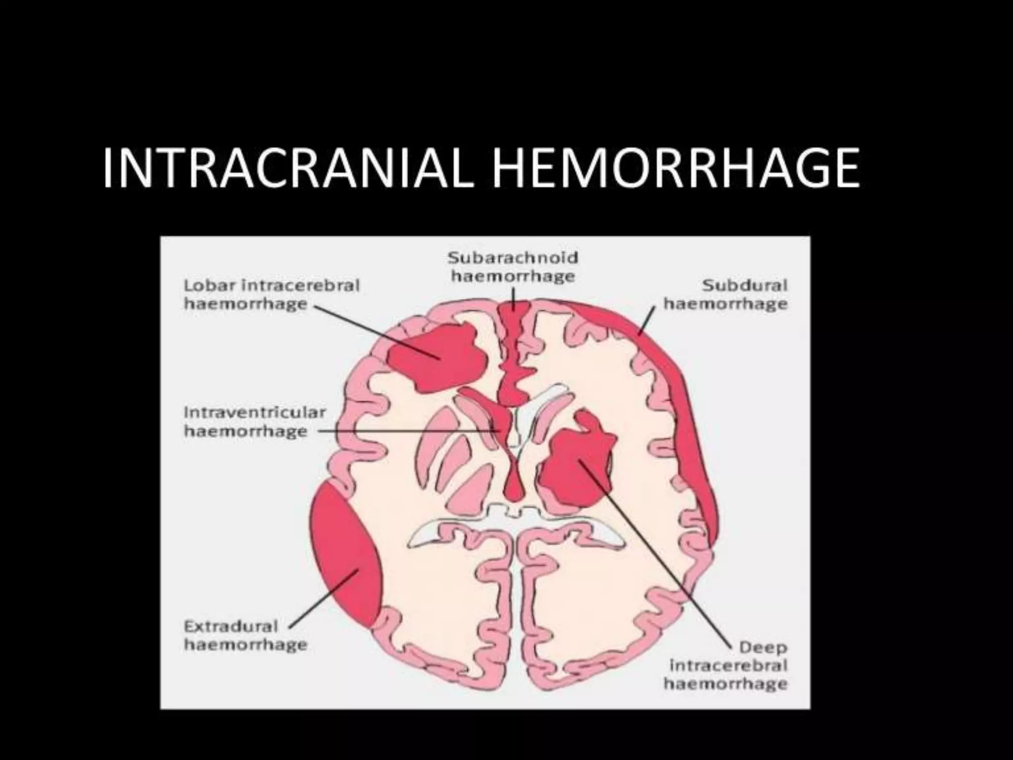 Epidural haematoma extradural haemorrhage | PPTX