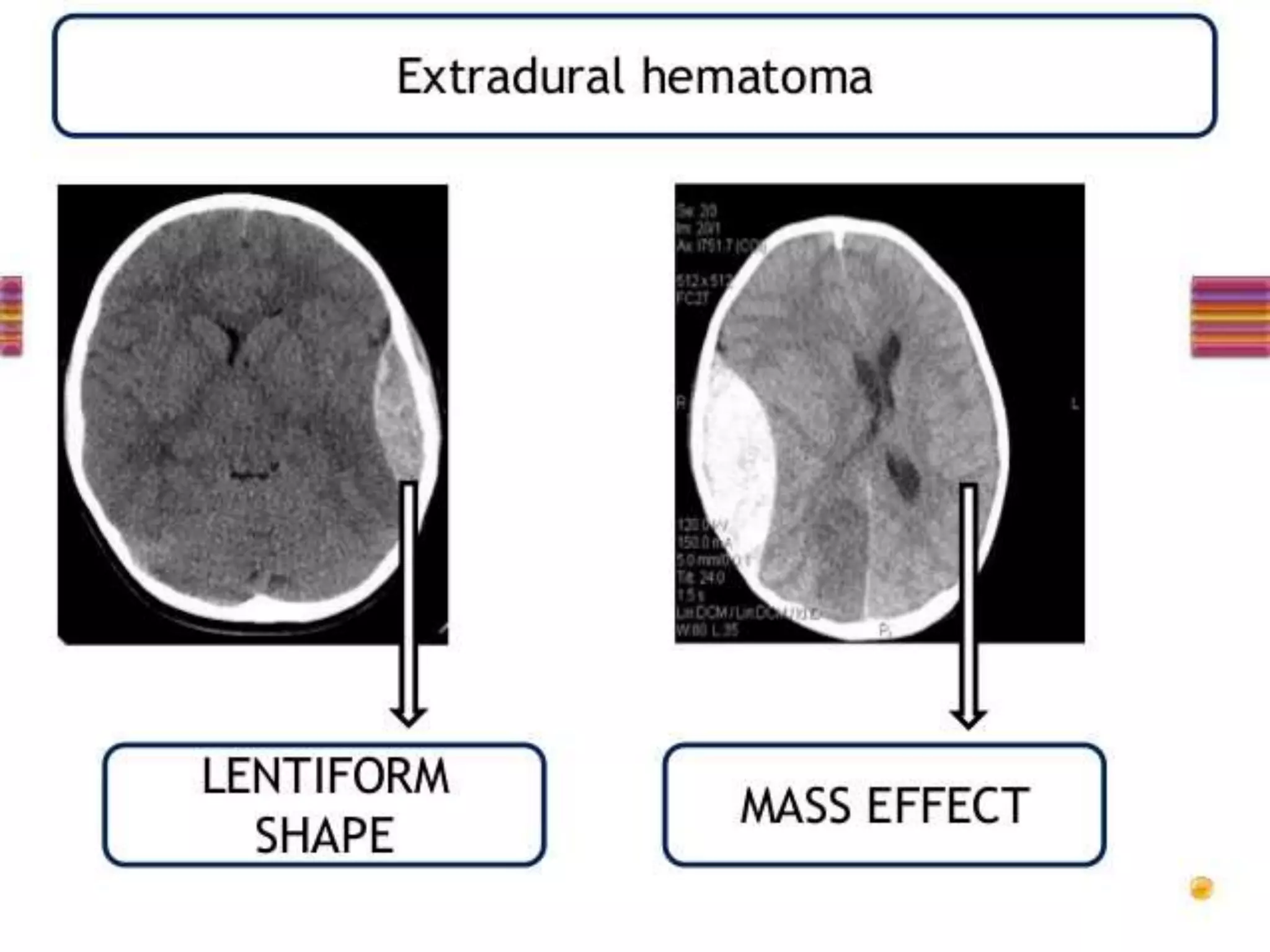 Epidural haematoma extradural haemorrhage | PPTX