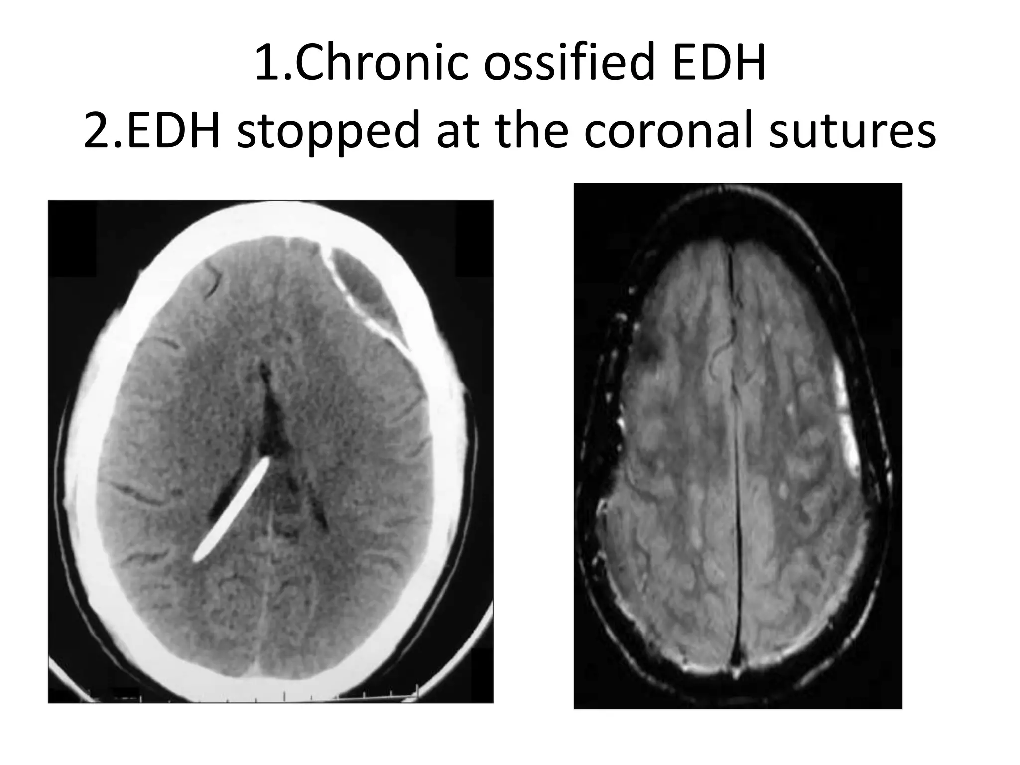 Epidural haematoma extradural haemorrhage | PPTX