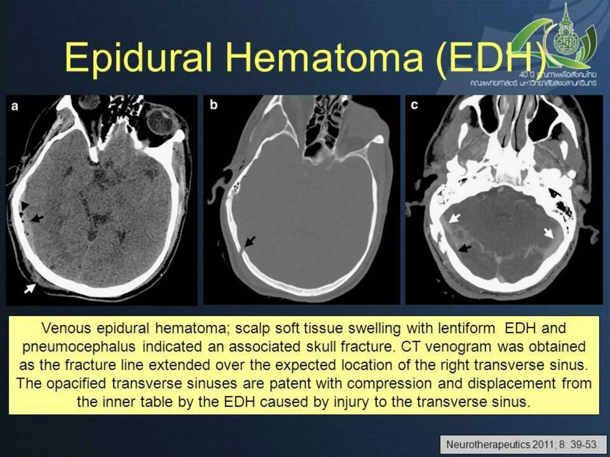 Epidural haematoma extradural haemorrhage | PPTX
