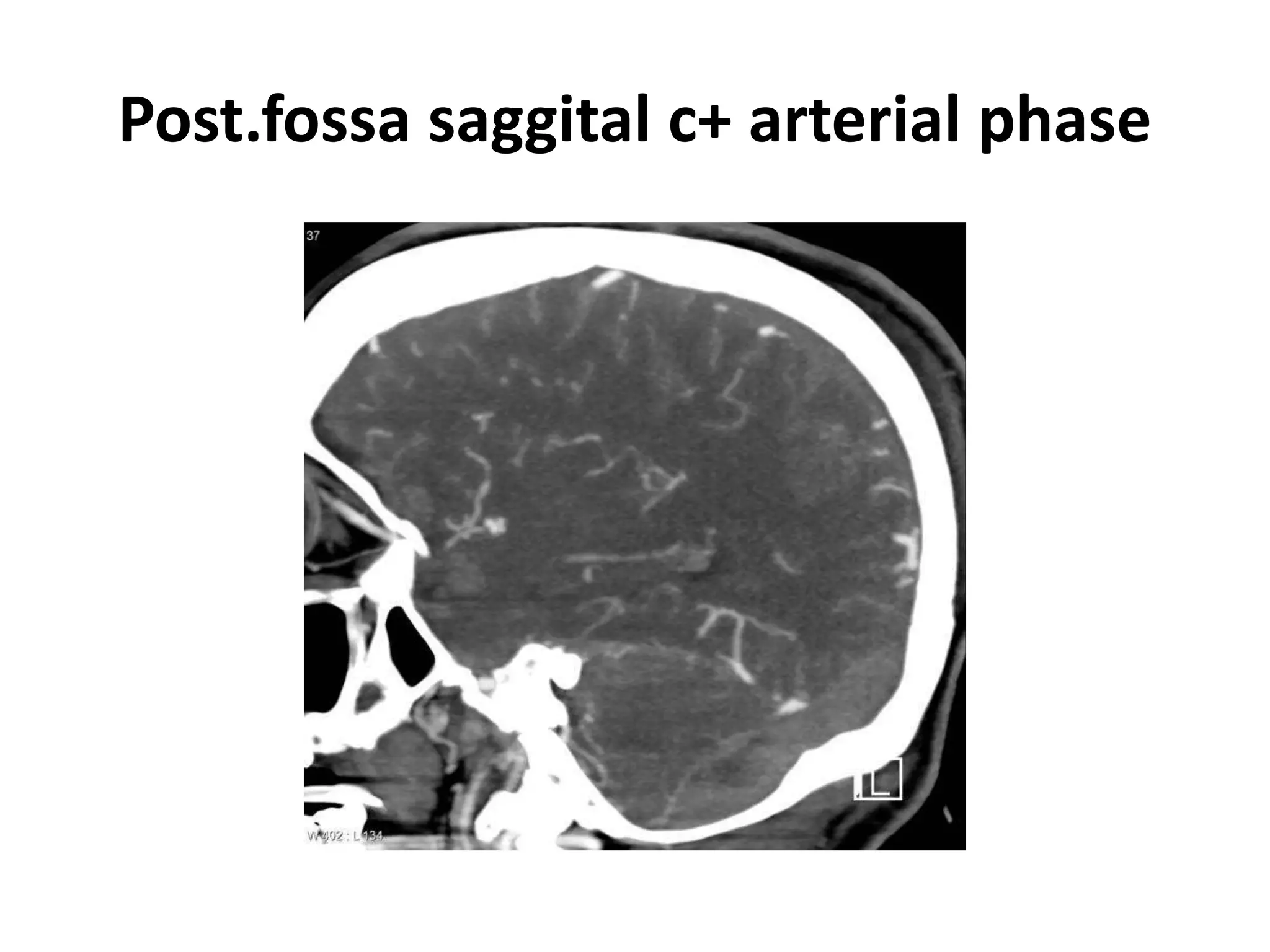 Epidural haematoma extradural haemorrhage | PPTX