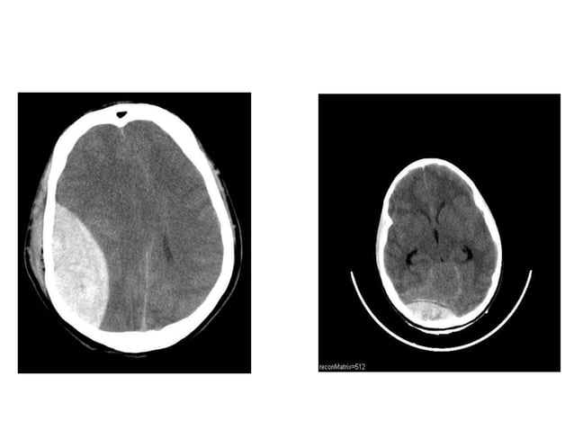 Epidural haematoma extradural haemorrhage | PPTX