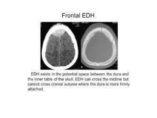 Epidural haematoma extradural haemorrhage | PPTX