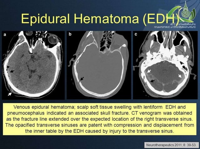 Epidural haematoma extradural haemorrhage | PPTX