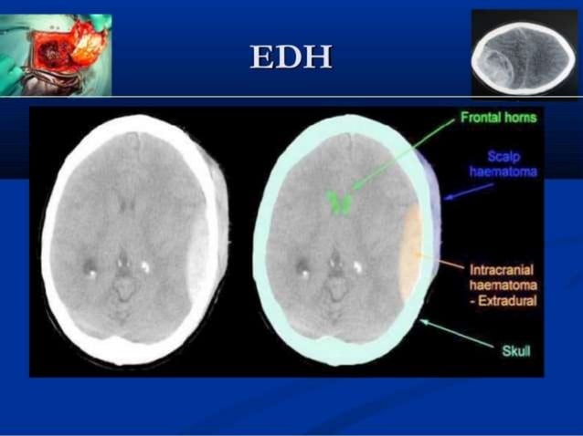 Epidural haematoma extradural haemorrhage | PPTX