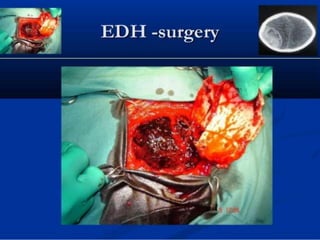 Epidural haematoma extradural haemorrhage | PPTX