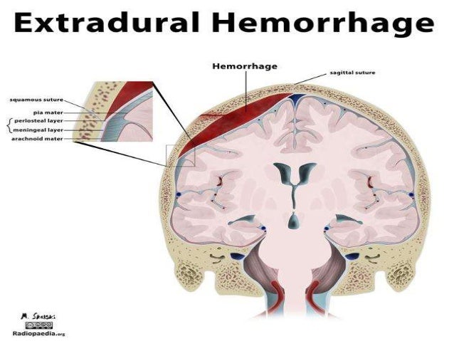 Epidural haematoma extradural haemorrhage