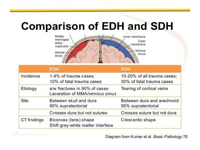 Epidural haematoma extradural haemorrhage