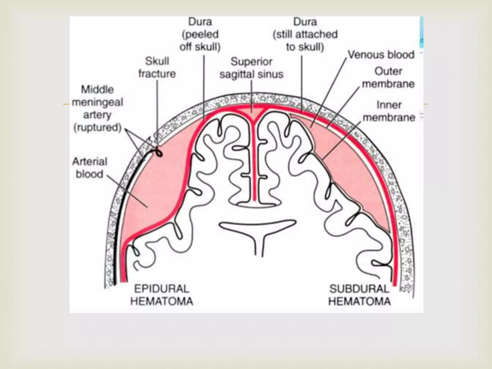 Epidural hematoma | PPTX