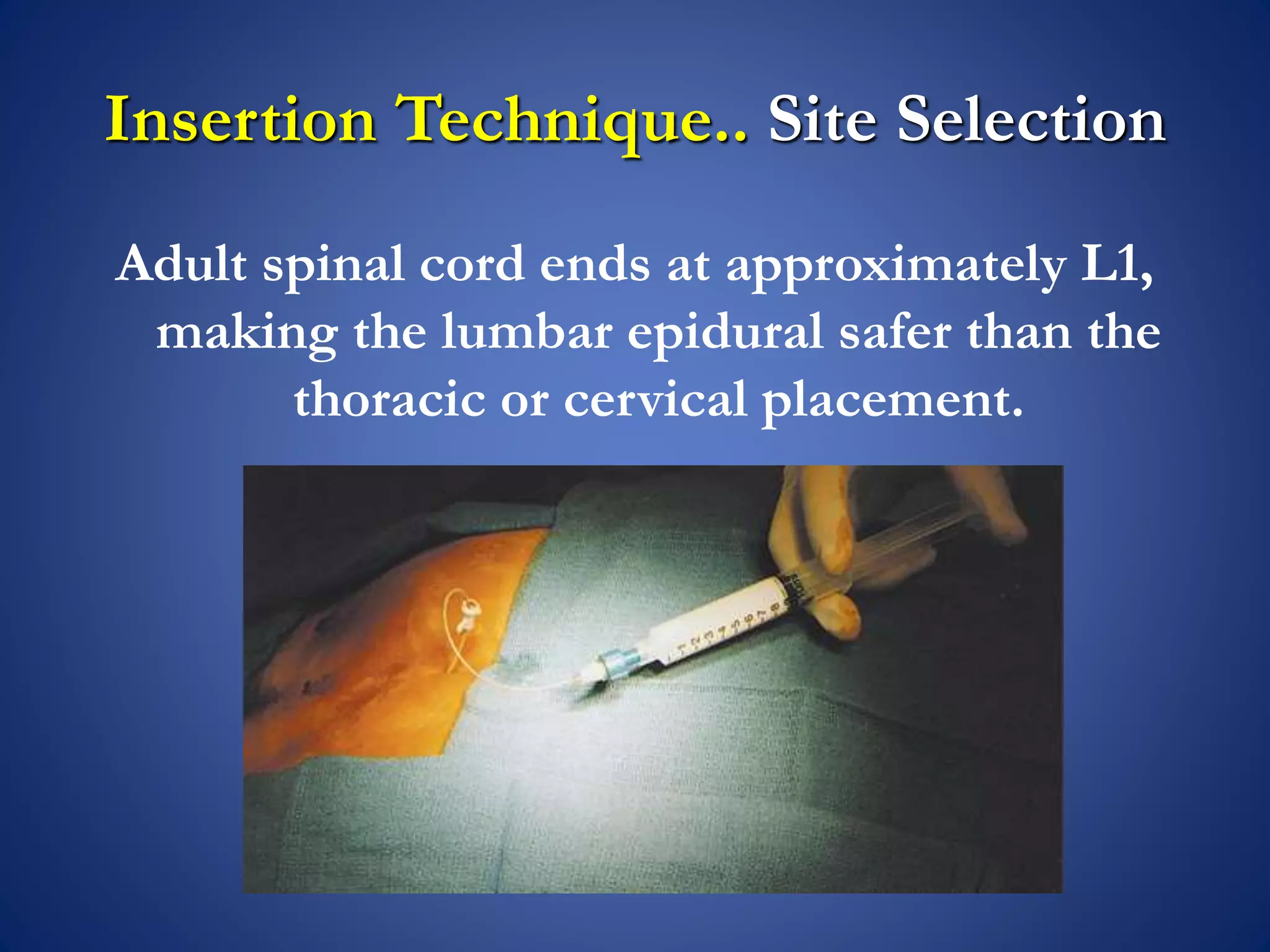 Epidural injections | PPTX