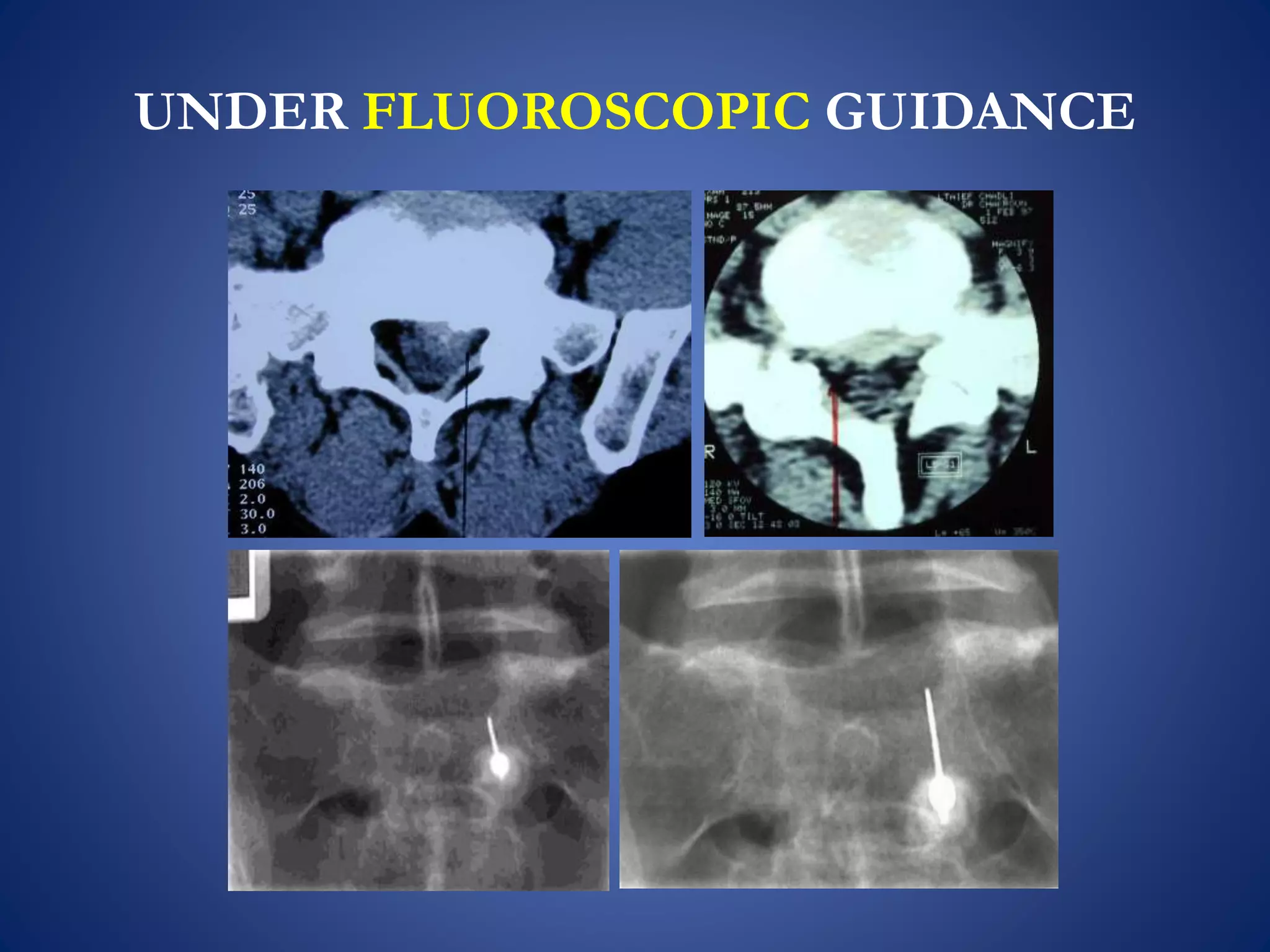 Epidural Injections Ppt