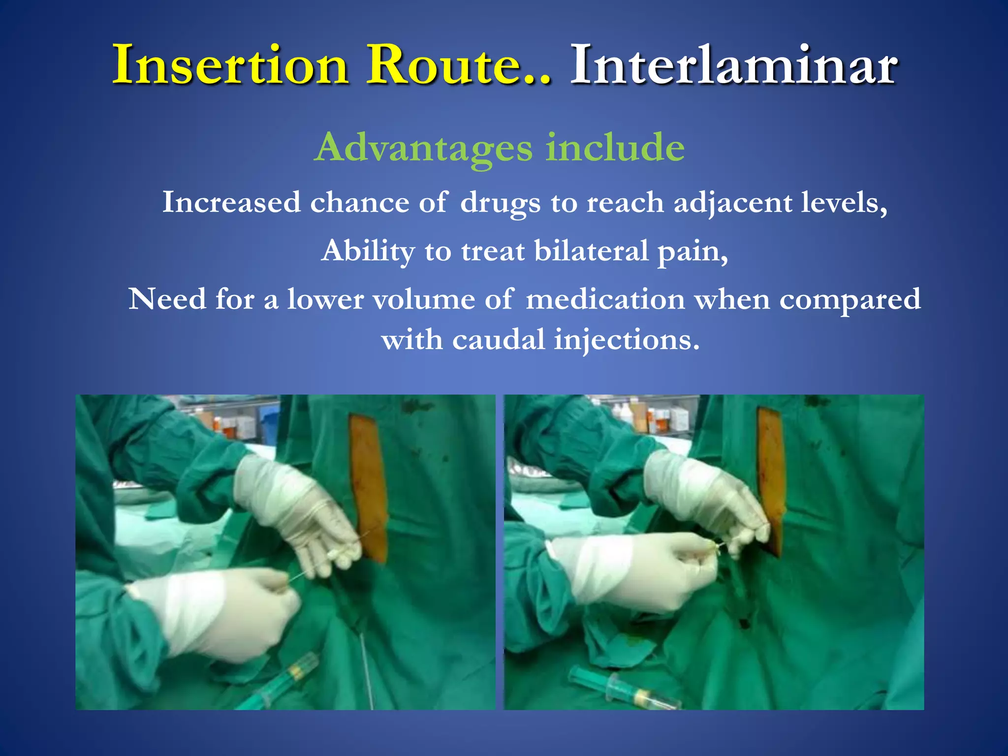 Epidural injections | PPTX