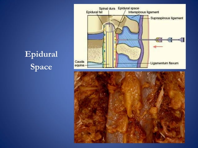 Epidural Injections Ppt