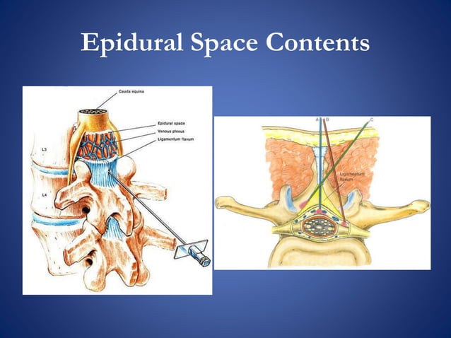 Epidural Injections Ppt