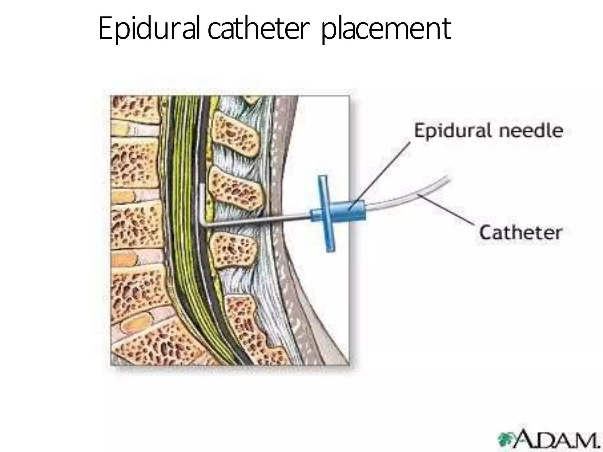 EPIDURAL PPT.pptx