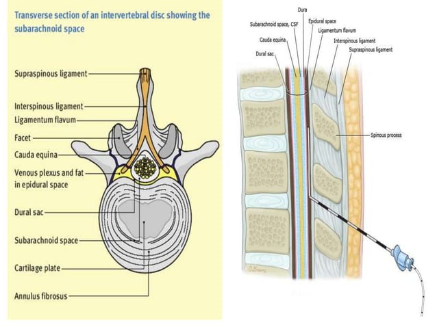 Epidural anesthesia.pptx