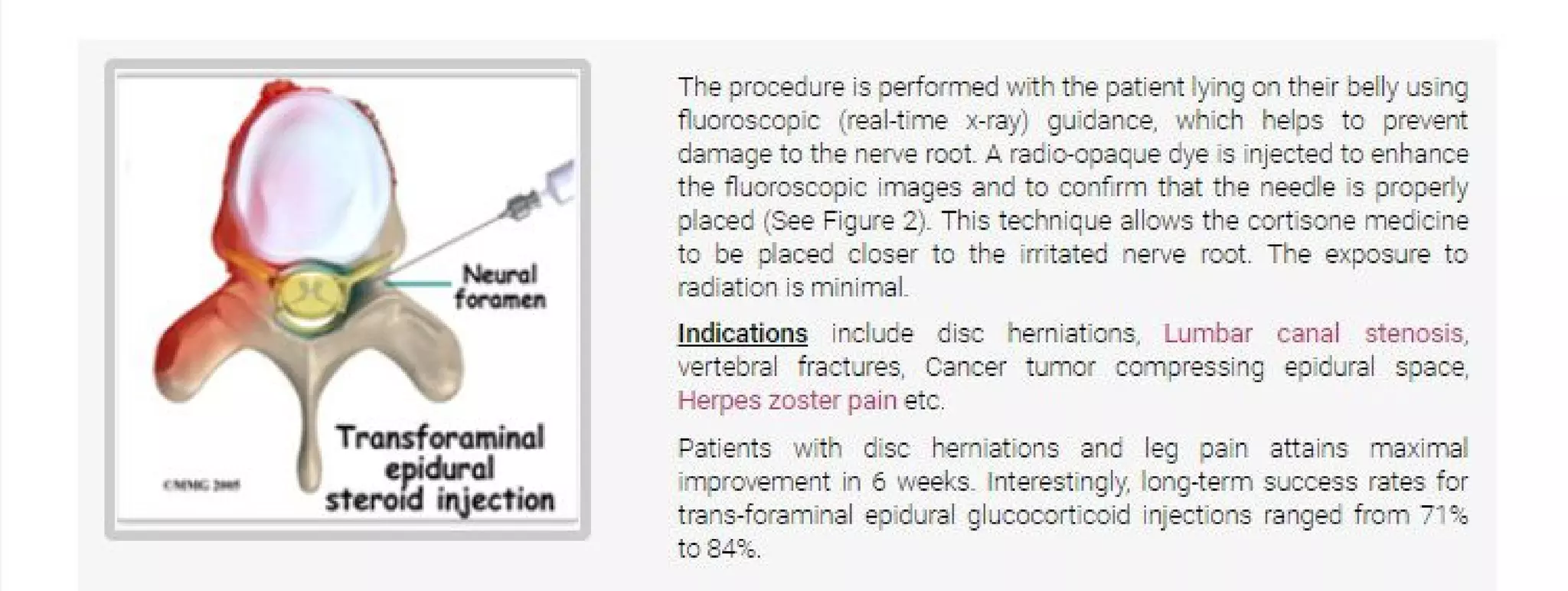 Epidural steroid injections for disc prolapse | PPT