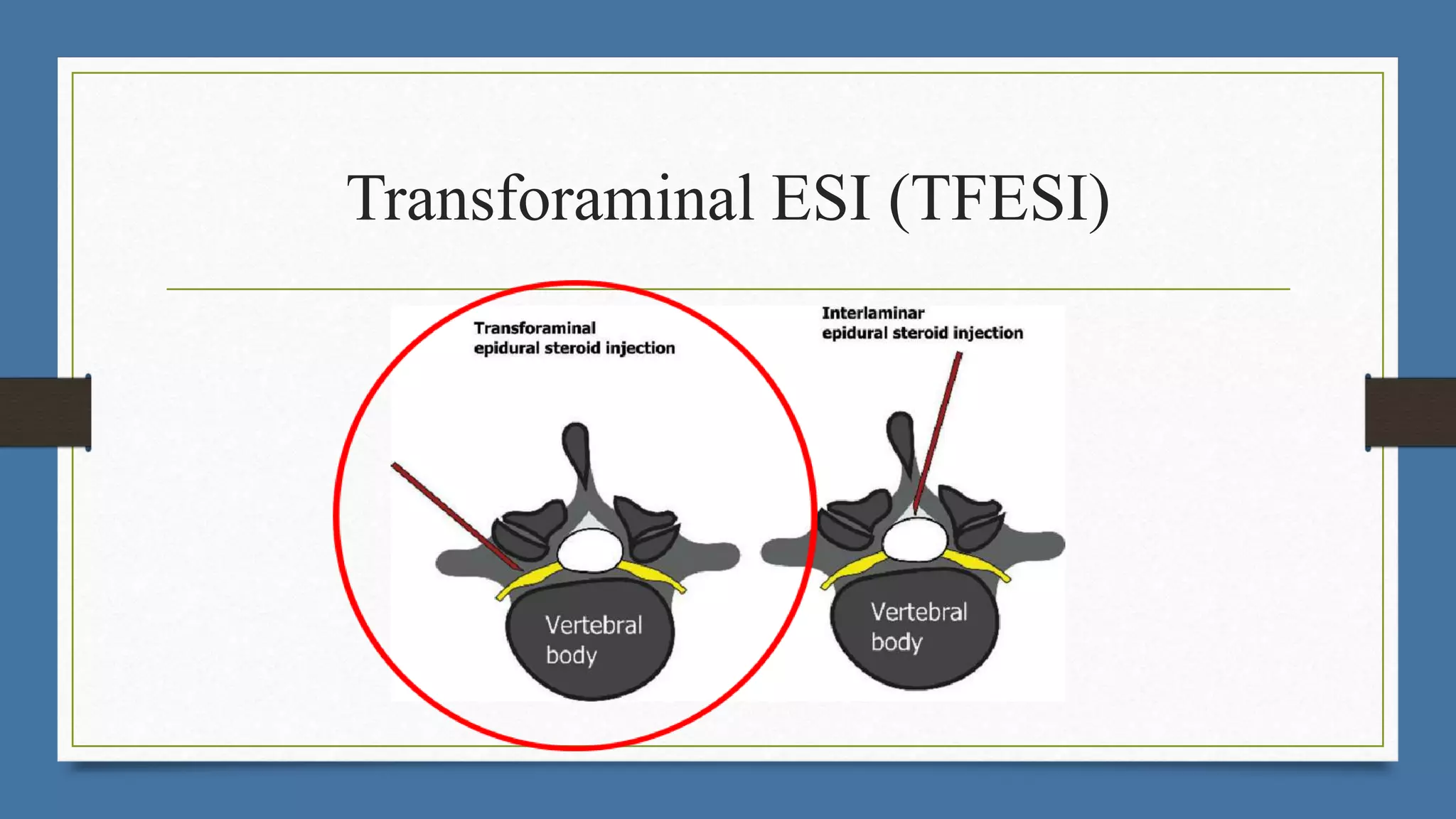 epidural steroids injections .pptx