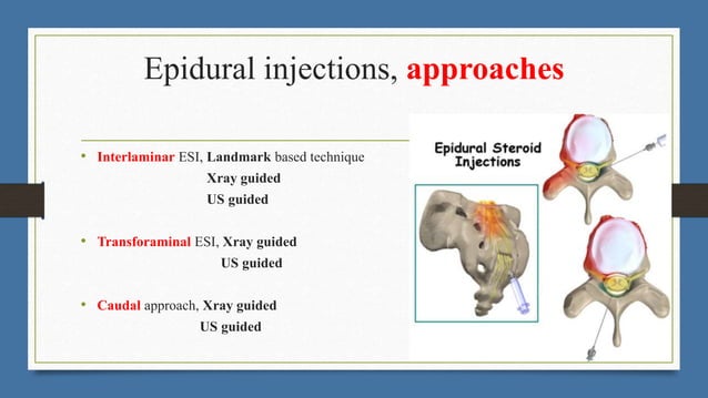 epidural steroids injections .pptx | Physical Therapy | Wellness