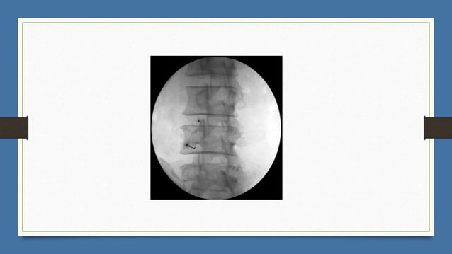 epidural steroids injections .pptx | Physical Therapy | Wellness