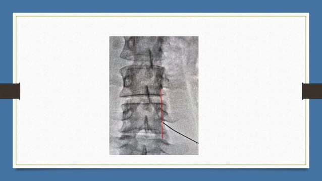 epidural steroids injections .pptx | Physical Therapy | Wellness