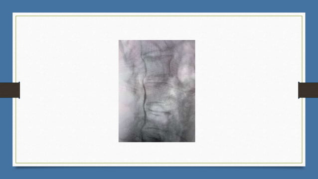 epidural steroids injections .pptx | Physical Therapy | Wellness