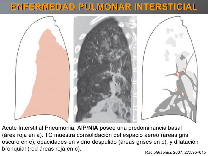 Enfisema Pulmonar Sintomas
