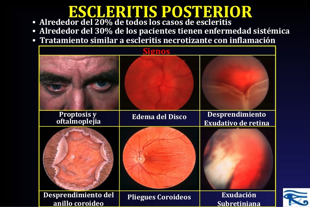 Epiescleritis y escleritis