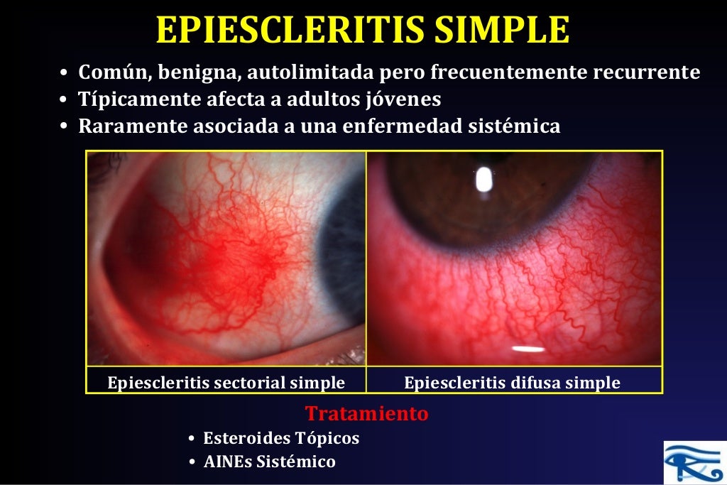 Epiescleritis y escleritis
