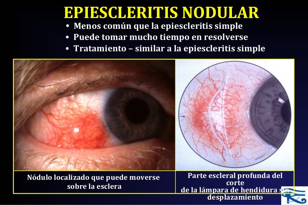 Epiescleritis y escleritis