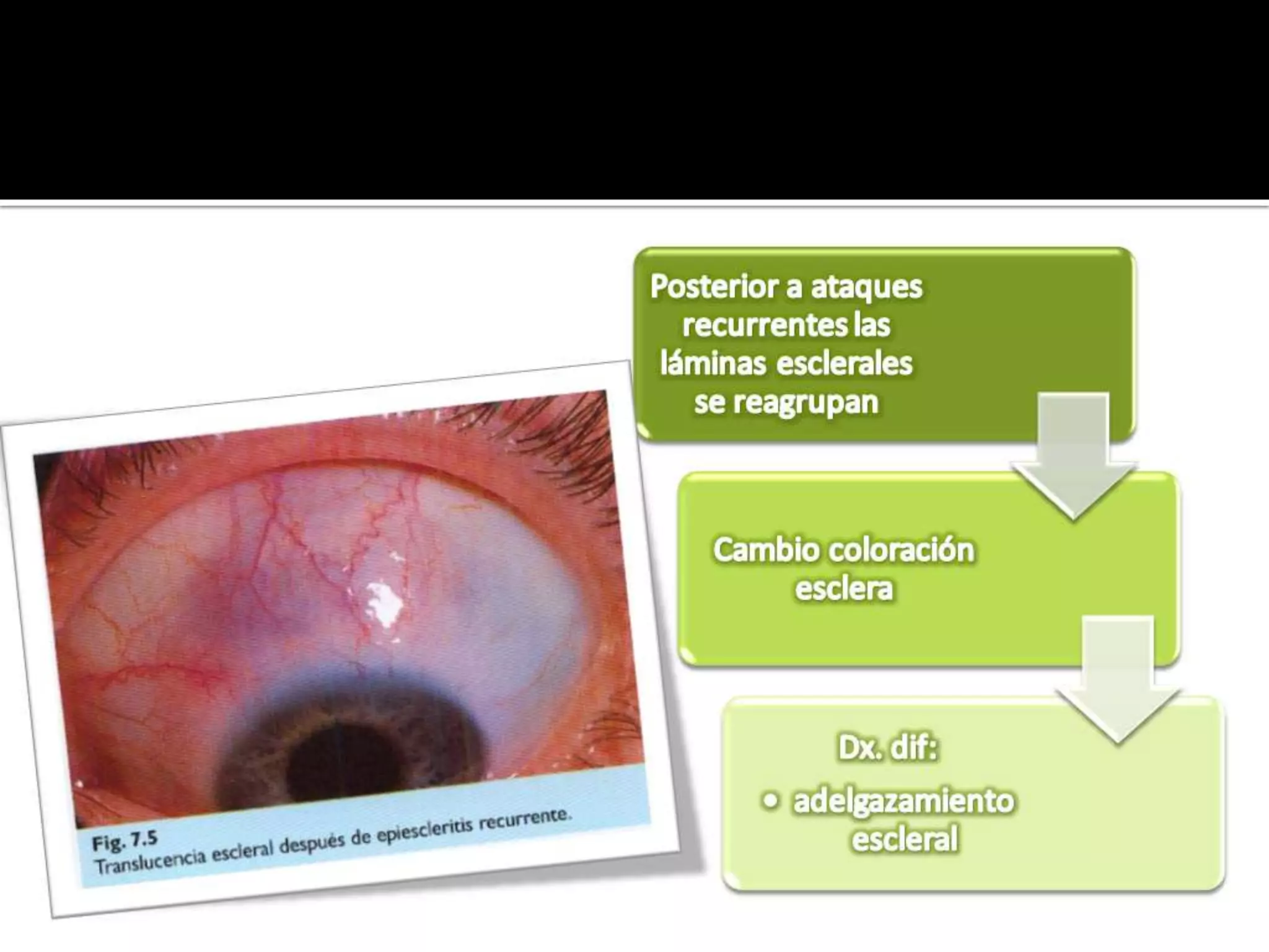 Epiescleritis Y Escleritis | PPTX