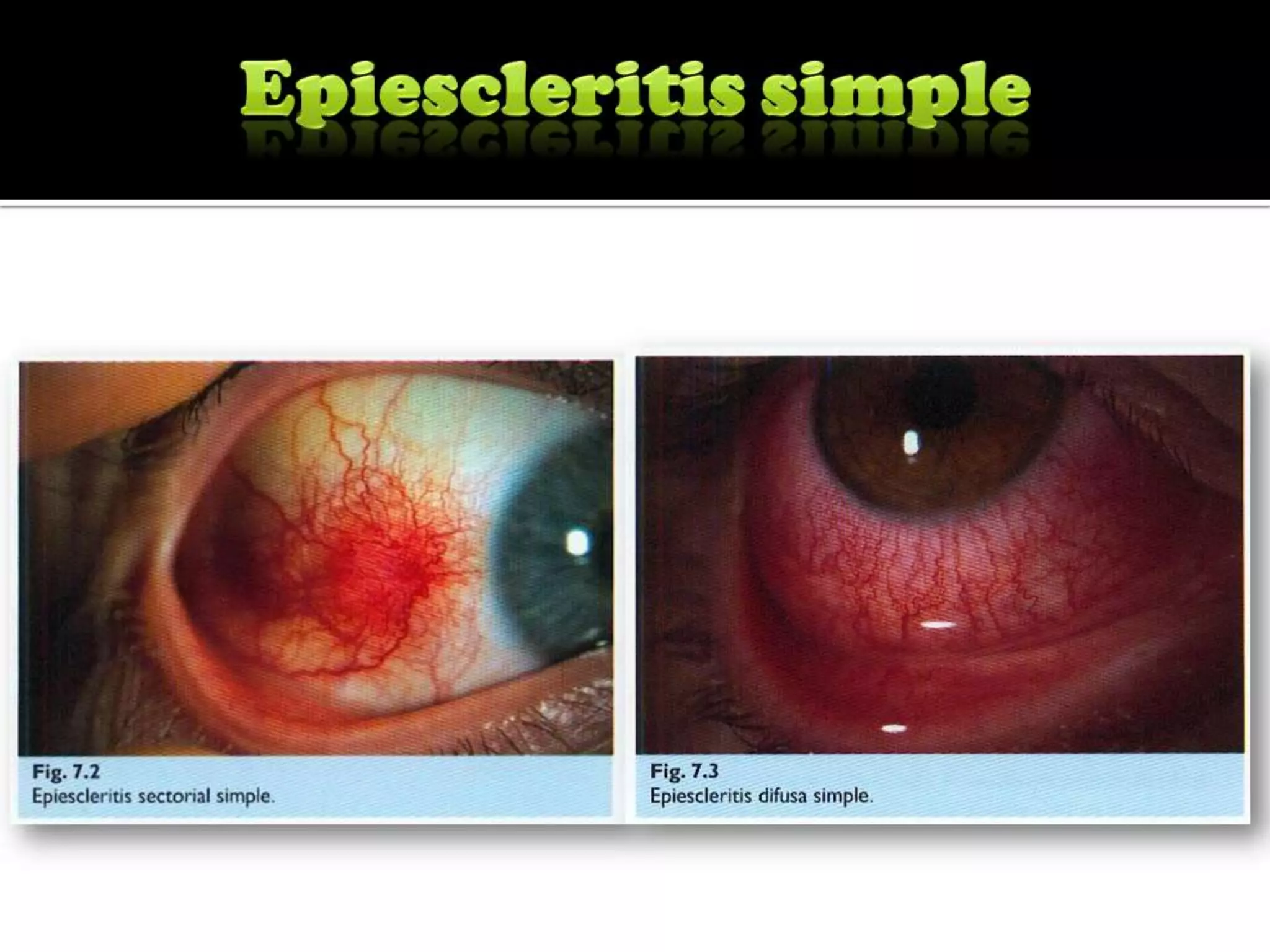 Epiescleritis Y Escleritis | PPTX