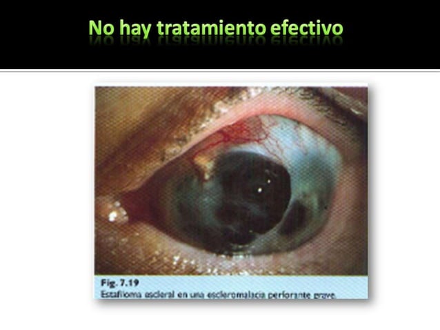 Epiescleritis Y Escleritis | PPTX