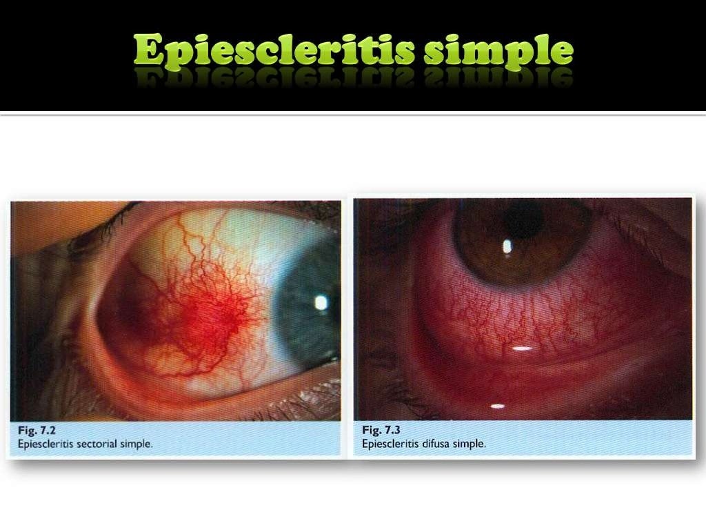 Epiescleritis Y Escleritis