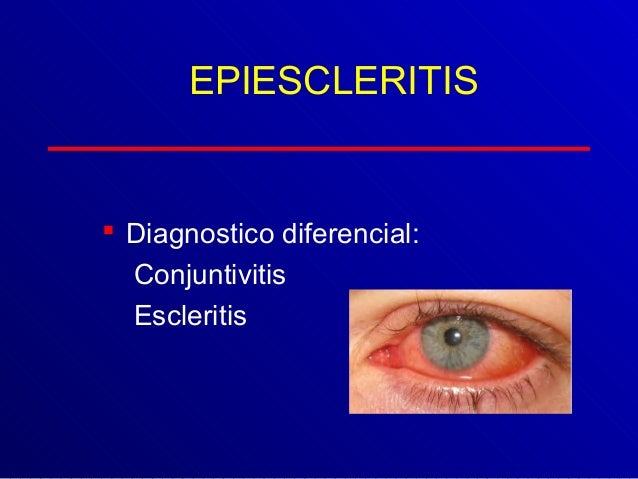 Epiescleritis y escleritis clase
