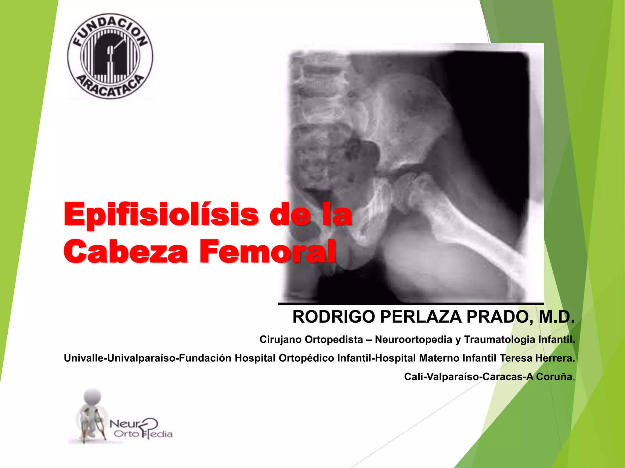 Epifisiólisis de la cabeza femoral | PPTX