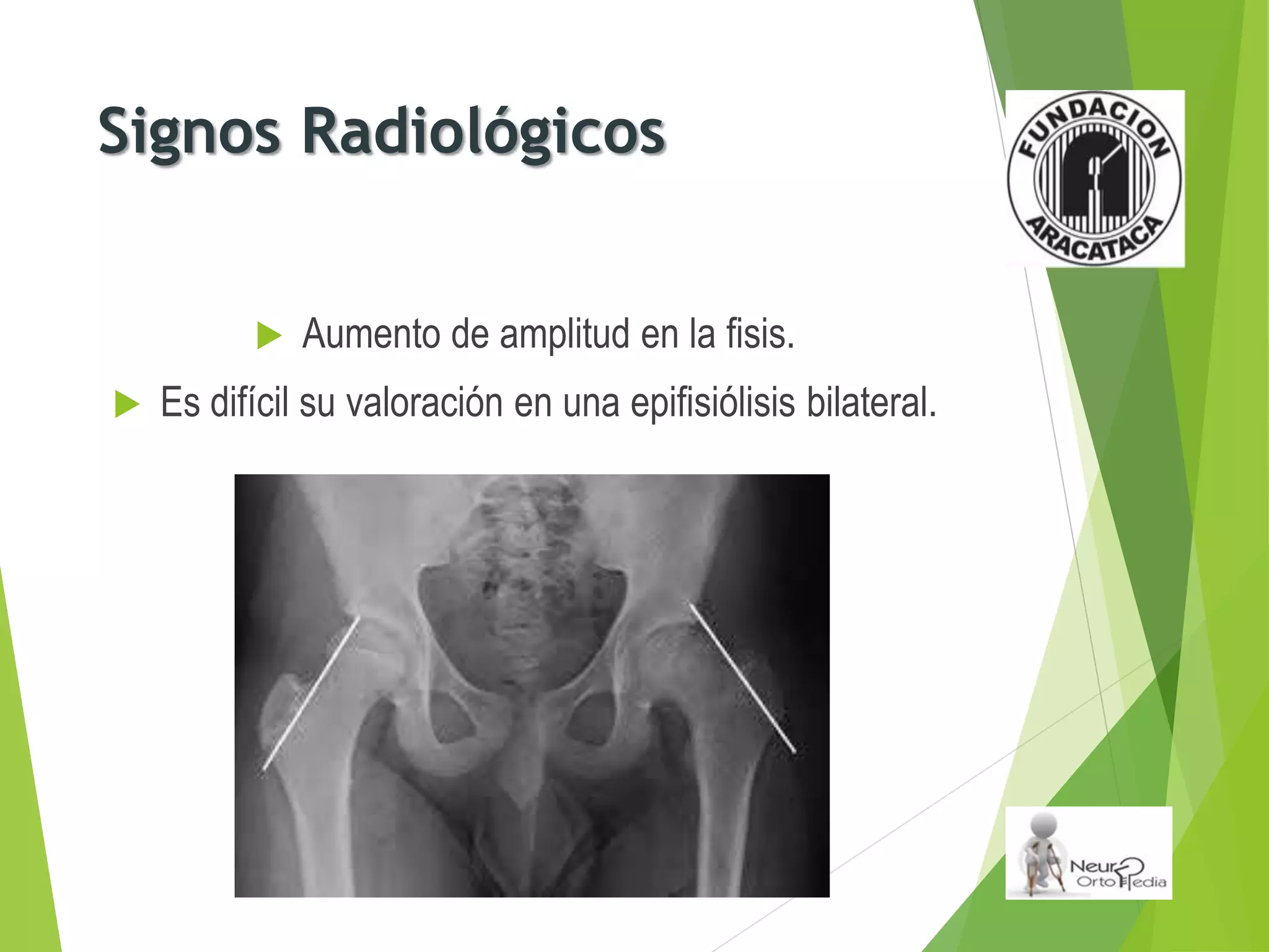 Epifisiólisis de la cabeza femoral | PPT