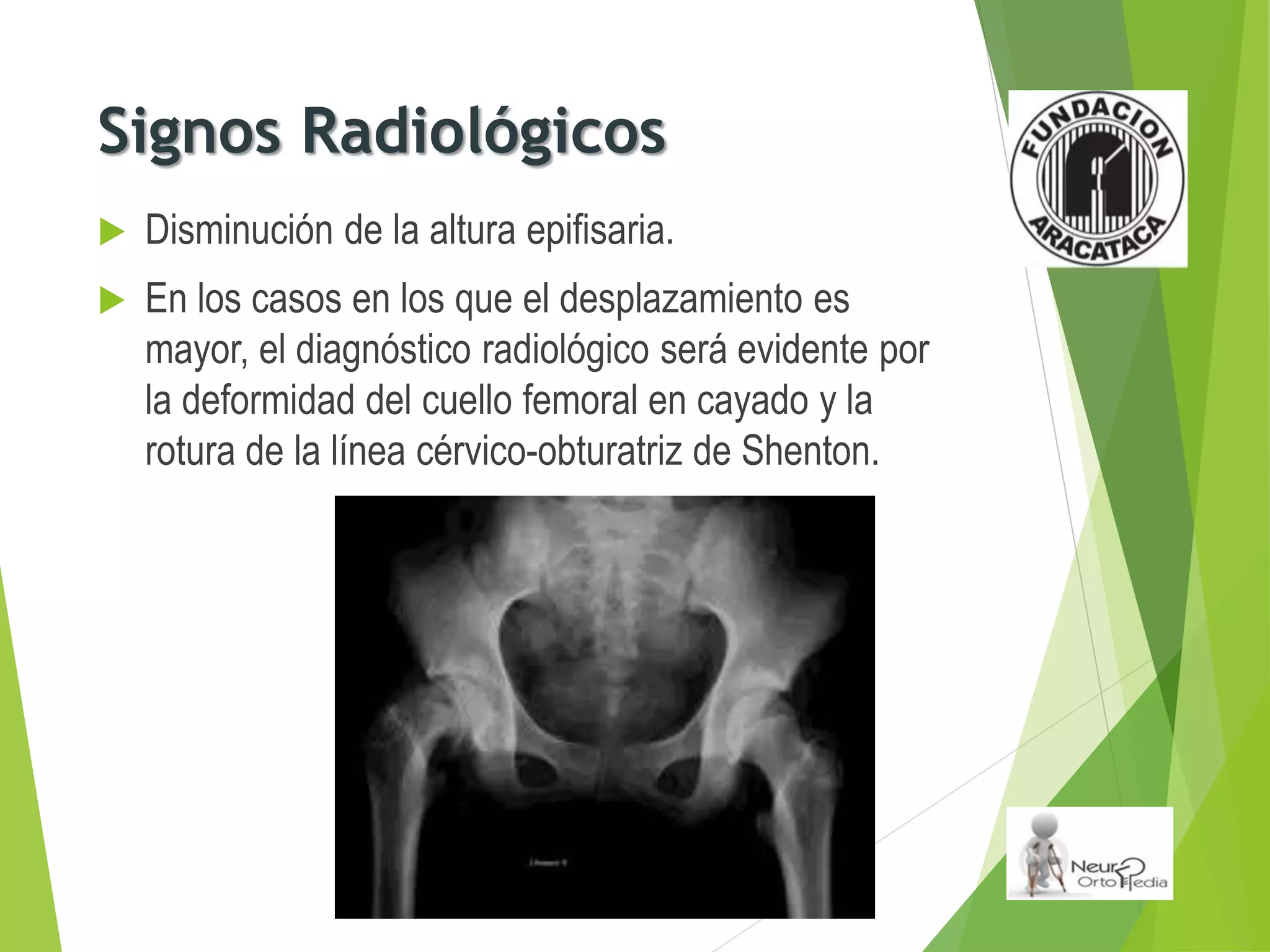 Epifisiólisis de la cabeza femoral | PPTX