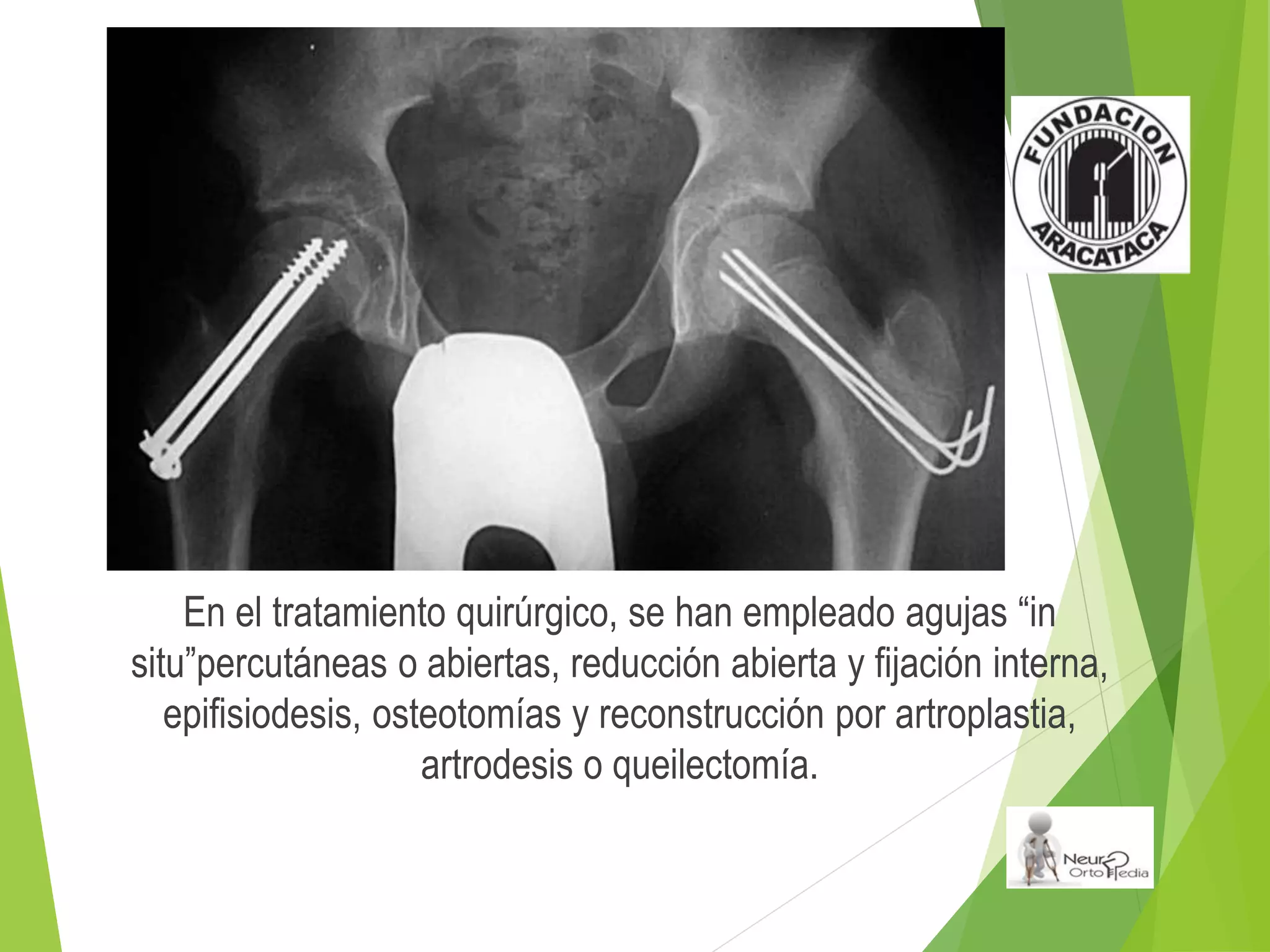 Epifisiólisis de la cabeza femoral | PPTX