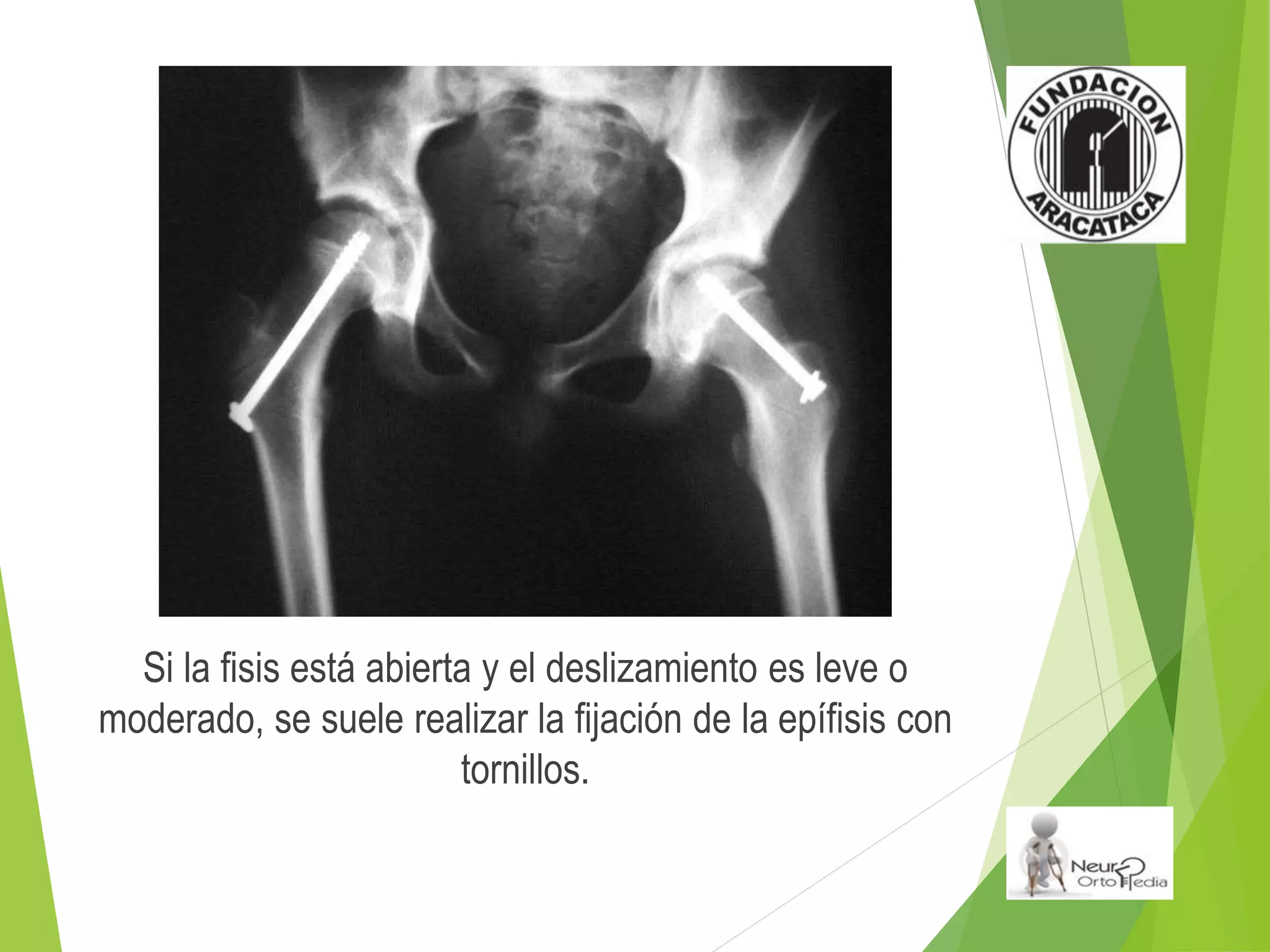 Epifisiólisis de la cabeza femoral | PPT