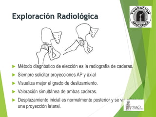 Epifisiólisis de la cabeza femoral | PPTX