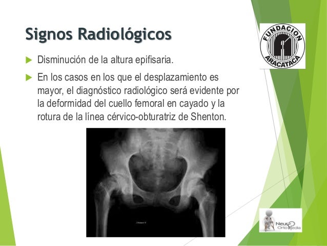 Epifisiólisis de la cabeza femoral