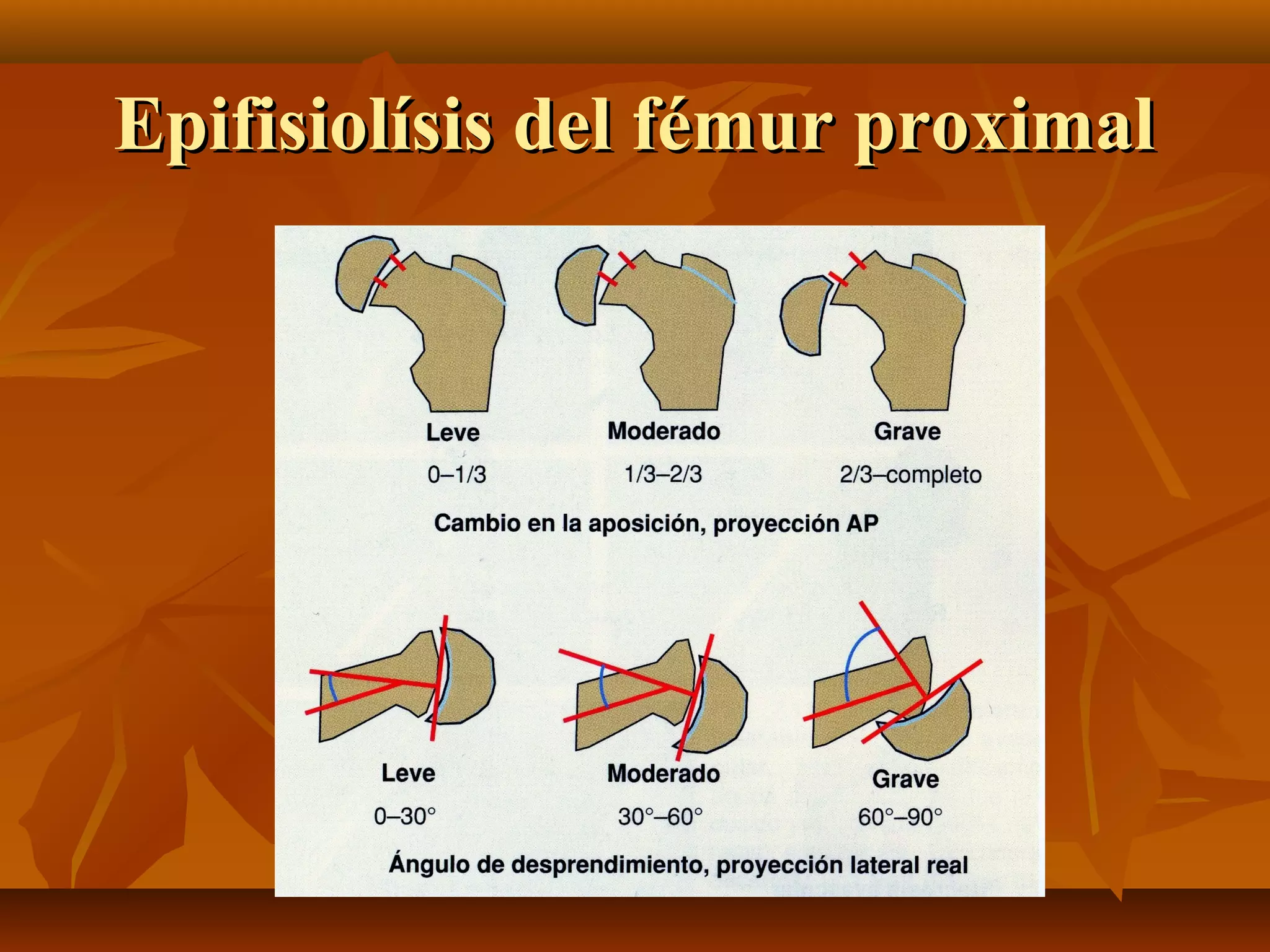 Epifisiolisis de-cadera-upap | PPT