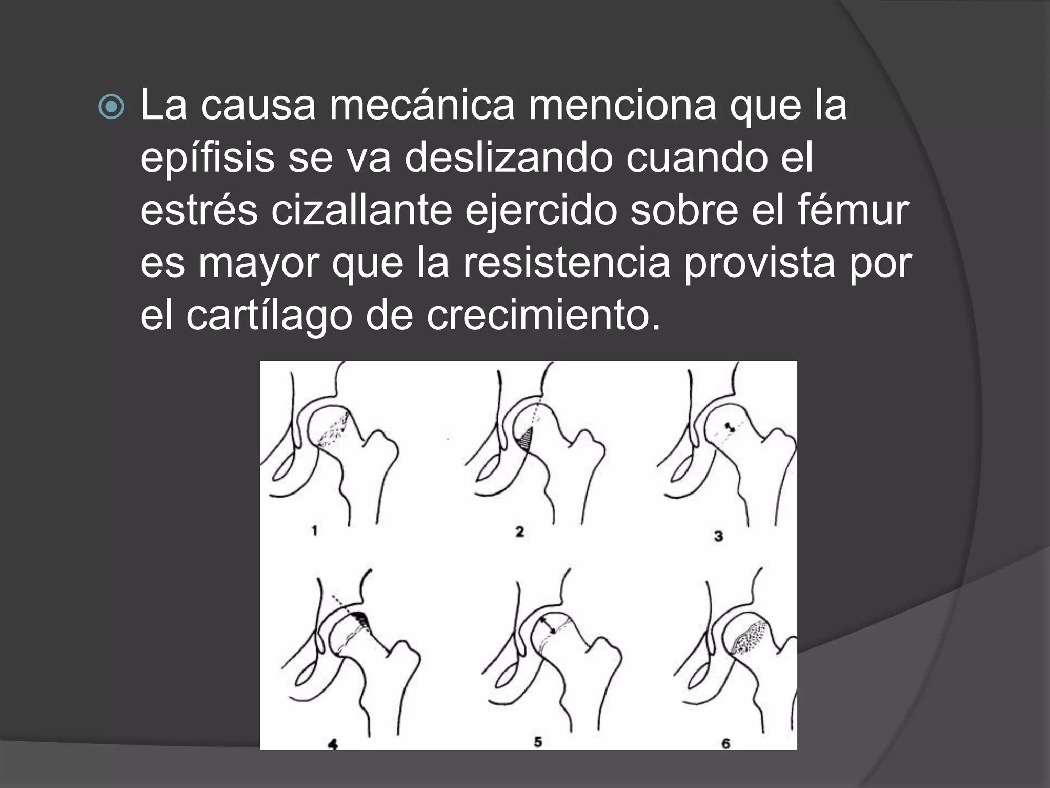 Epifisiolisis capital femoral | PPTX | Bone and Joint Conditions ...