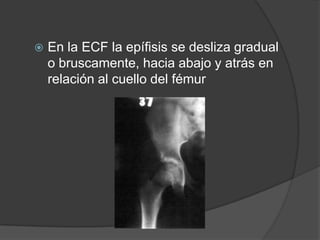Epifisiolisis capital femoral | PPTX