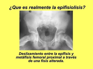 Epifisiolisis Evidencia En El Manejo QuirúRgico | PPT