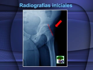 Epifisiolisis femoral proximal | PPT
