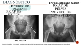PRESENTACION PPT EPIFISIOLISTESIS_DE_CADERA[1].pptx