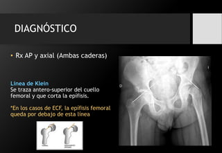 Epifisiopatias | PPTX